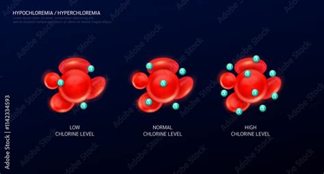 Hyperchloremia Is An Electrolyte Disorder Chlorine In Red Blood Cells