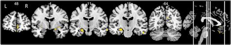 Positive Correlations Of Delayed Primacy Recall And Right Hippocampus Download Scientific