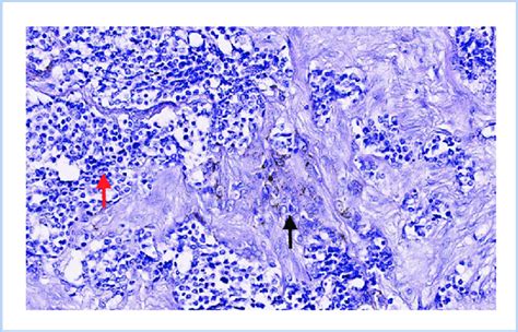Melanotic Neuroectodermal Tumor Of Infancy Small Rounded Cells With