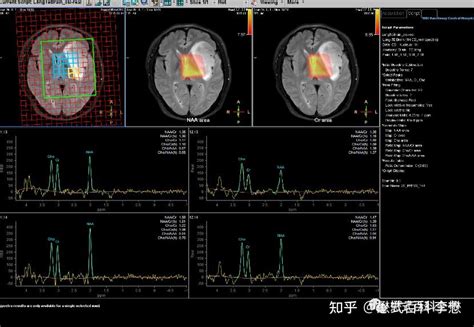 什么是化学位移成像CSI 知乎