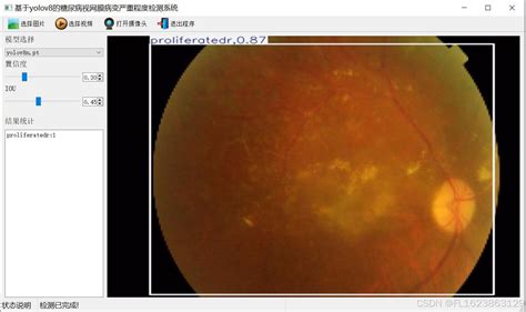 基于yolov8的糖尿病视网膜病变严重程度检测系统python源码pytorch模型评估指标曲线精美gui界面圆锥角膜筛查 Python Github Csdn博客