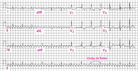 Flutter Atrial Doenças Cardiovasculares Manuais Msd Edição Para Profissionais