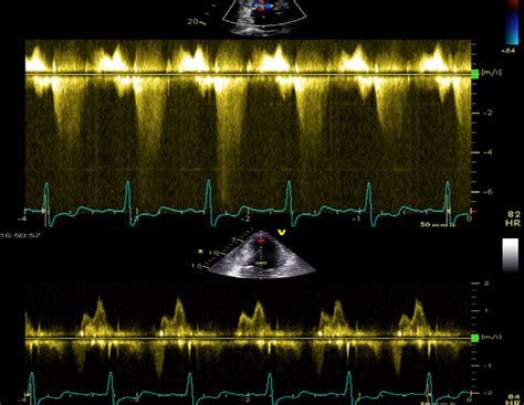 Continuous Wave Doppler Interrogation Of The Mitral Valve Showing