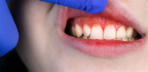 Bleeding Gums How To Spot And Treat The Problem