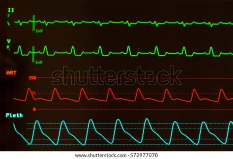 Intraventricular Conduction Delay 사진 및 이미지 Shutterstock