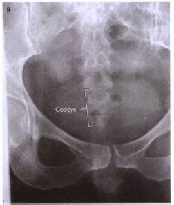 X Ray Of The Coccyx Ap Axial Projection Radtechonduty