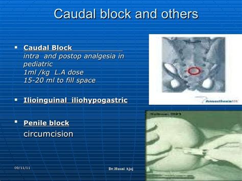 What Is The Definition Of Caudal Block At Deidra Mckoy Blog