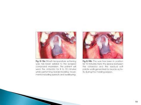 Acquired Maxillary Defects Copy Removeable Ppt