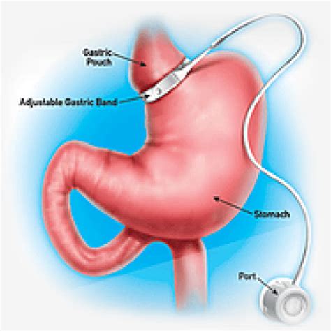 Laparoscopic Adjustable Gastric Band Pros And Cons
