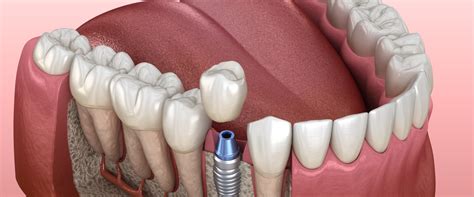 Which Bone Density Is Best For Dental Implants A Comprehensive Guide