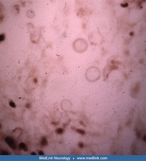 Cryptococcal Meningitis Medlink Neurology