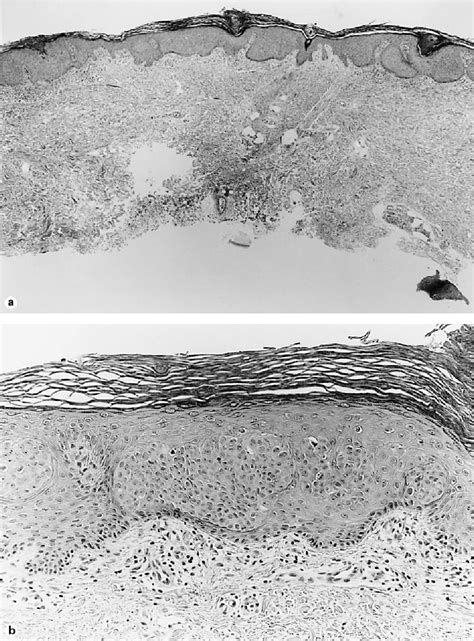 Hidroacanthoma Simplex A Case Report And Analysis Of 70 Japanese Cases Semantic Scholar