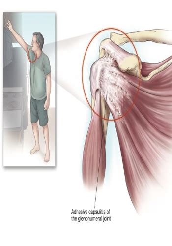 Adhesive Capsulitis Prof Dr Serbülent Gökhan Beyaz