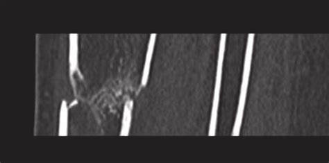 Ct Scan With Delayed Ossification At Proximal Osteotomy Download