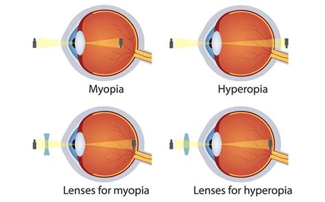 types of refractive errors and how they are corrected dr anisha