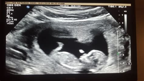 Weeks NT Scan Photos BabyCenter