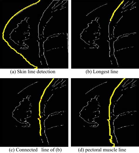 Figure 1 From Segmentation Of The Pectoral Muscle Boundary In Breast Mr Images Semantic Scholar
