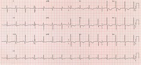 Right Axis Deviation Ecg Book