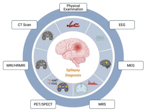 Epilepsy Brain Diagram