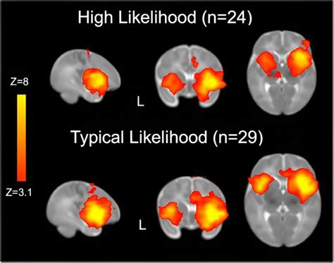 On Linkedin Study Finds Distinct Brain Connectivity Patterns
