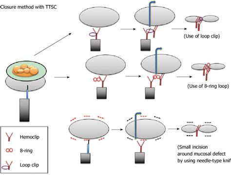 Diagram Of A Closure Technique With The Additional Use Of A Loop Clip