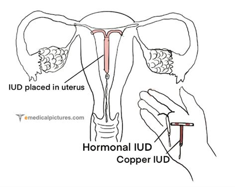 Iud Intrauterine Device Diagram And Images Medical Pictures And