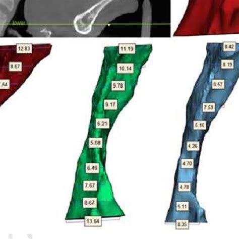 airway segmentation and analysis red is the pre operative airway