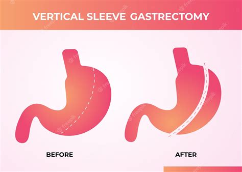 Premium Vector Laparoscopic Sleeve Gastrectomy Vertical Gastrectomy