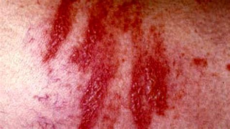 Phytophotodermatitis อาการ สาเหตุและอื่น ๆ แพทย์ของคุณ 2025