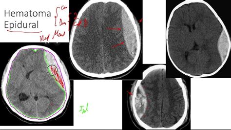 Image Hemorragia Epidural Tc Axial Manual Merck