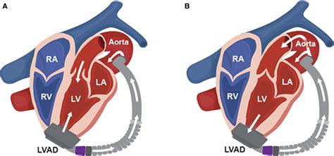 Left Ventricular Assist Devices A Primer For The General Cardiologist Journal Of The American