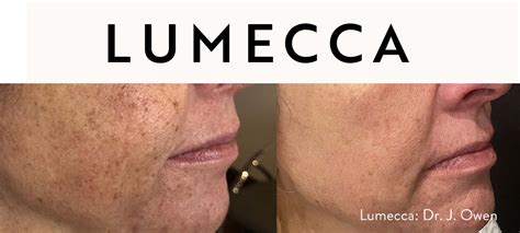 Inmode Optimas Artemis Esthetics Wellness