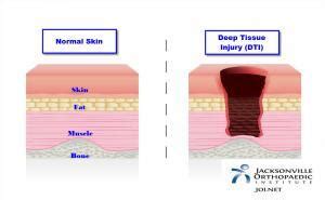 Deep Tissue Injury Or DTI JOI Jacksonville Orthopaedic Institute