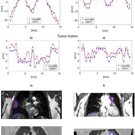 Diaphragm And Tumor Motion Measured On Cine Mri Data Red And Download Scientific Diagram