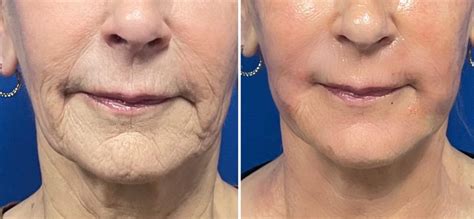Microneedling With Exosomes Before And After