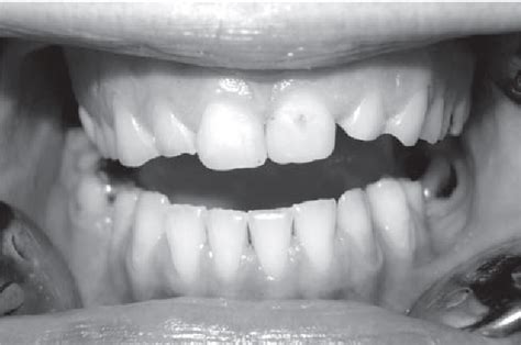Figure 1 From Extensive Tooth Wear A Case Report Semantic Scholar