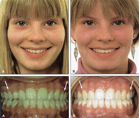 Nonextraction Class Ii Division 1 Case With Impacted Maxillary Right Download Scientific