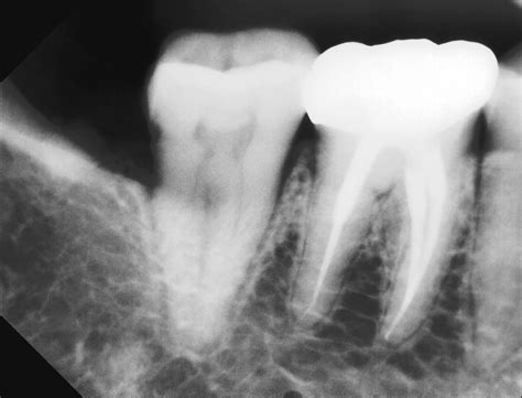 Apical Periodontitis And Pdl Widening How To Treat This Details In Comment R Askdentists