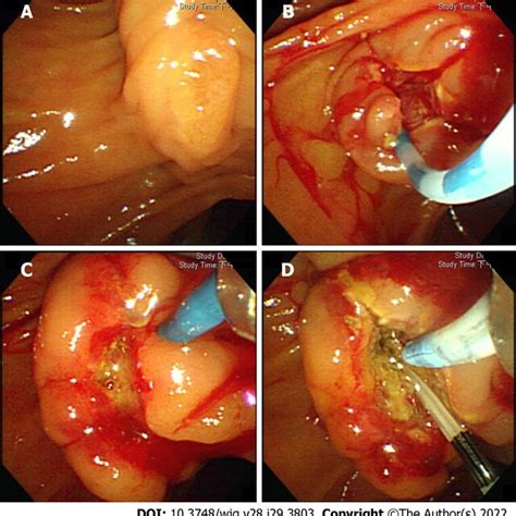 Interval Endoscopic Retrograde Cholangiopancreatography 3 D After The