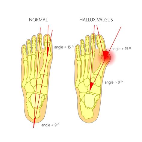 Toes Crossing Over 2026 Causes Treatment Dpm