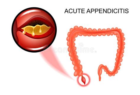 3d Illustration Of Colon Polyps Polyp In The Intestine Isolated Black