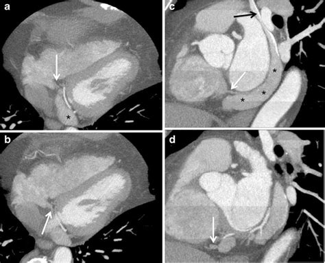 1 A 32 Year Old Male With Cs Ostial Atresia And A Persistent Lsvc Download Scientific Diagram