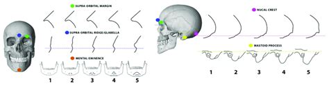 The Five Points Scale Scoring System For The Five Cranial Traits