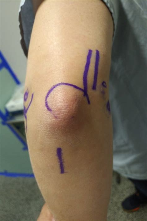 Elbow Anatomy Sport Med Babe