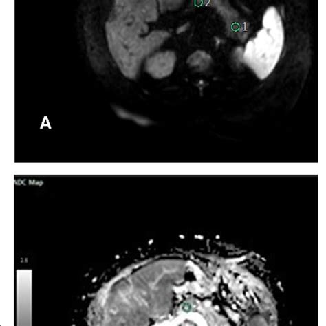 A B On Dw Mri Diffuse Restriction Througout The Pancreas A And On