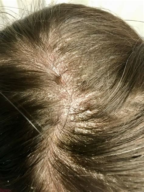 Psoriasis Scalp
