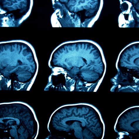 Anxiety Disorder Brain