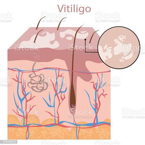 컷 어웨이에서 Vitiligo 또는 탈색소 침착을 가진 피부 흰색 배경에 분리 된 Vitiligo와 인간의 피부과 문제를 가진 해부학 평면 벡터 스톡 벡터 그림 내부