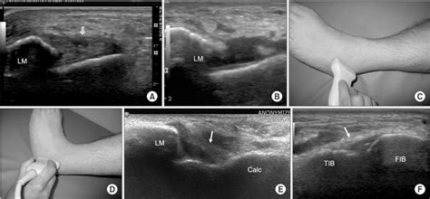 Ultrasonography Images Showing The Sprained Ankle Ligaments A An