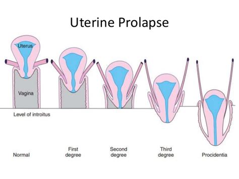 Diagram Of A Prolapsed Uterus Uterus Prolapse Pelvic Cause E